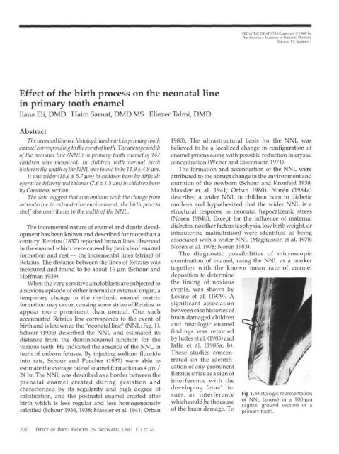 Effect of the birth process on the neonatal line in primary tooth enamel