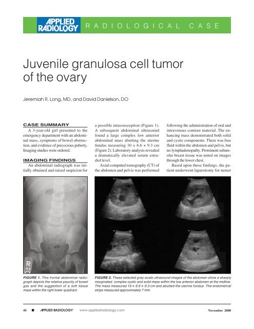 Juvenile Granulosa Cell Tumor Of The Ovary Applied Radiology Online