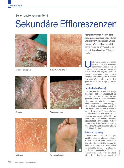 Effloreszenzen Detail Doccheck Pictures Effloreszenz - DocCheck Flexikon