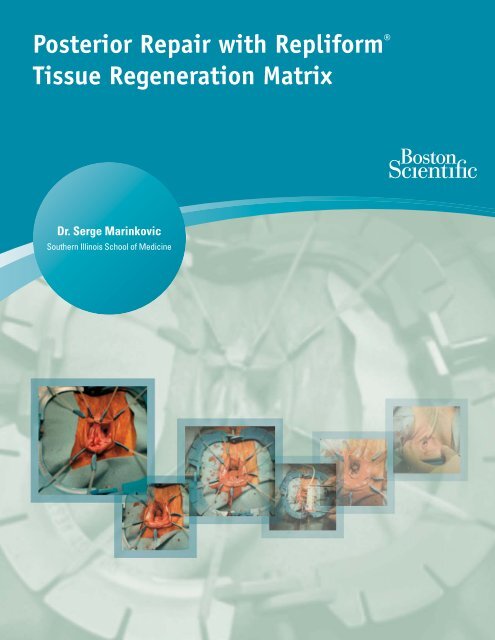 Repliform - Boston Scientific