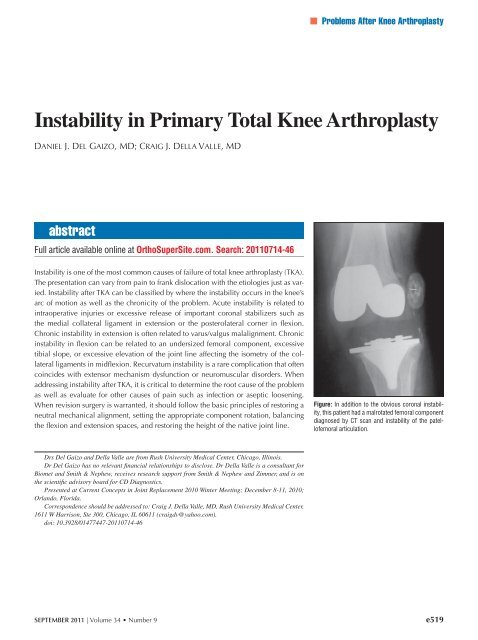 Instability in Primary Total Knee Arthroplasty - Healio