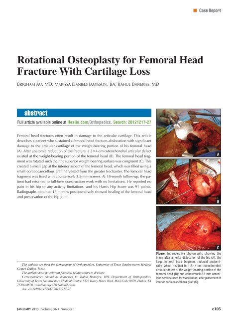 Rotational Osteoplasty for Femoral Head Fracture With ... - Healio