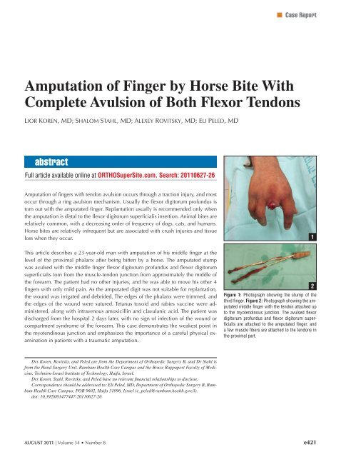Amputation of Finger by Horse Bite With Complete Avulsion ... - Healio