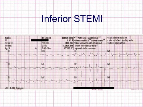 Inferior STEMI