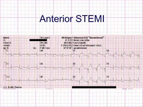 Anterior STEMI
