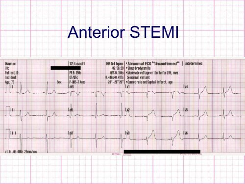 Anterior STEMI