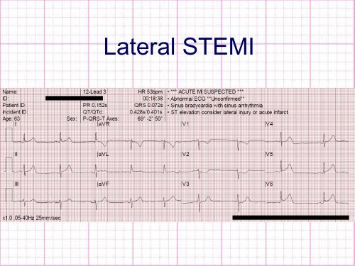 Lateral STEMI