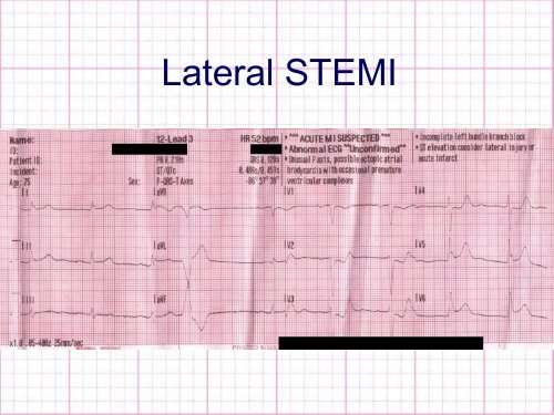 Lateral STEMI