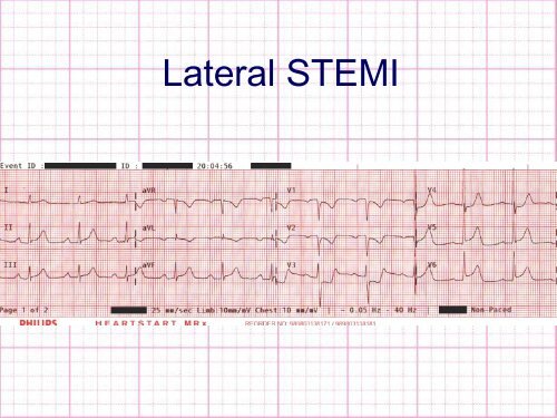 Lateral STEMI