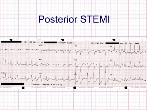 Posterior STEMI