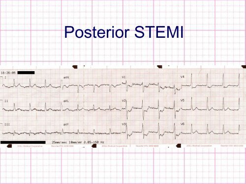 Posterior STEMI