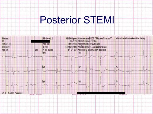Posterior STEMI