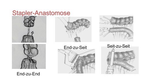 Stapler-Anastomose End-zu