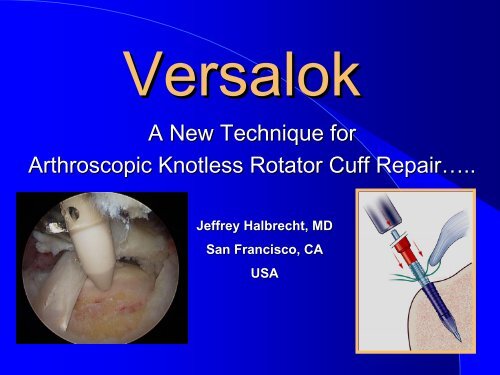 A New Technique for Arthroscopic Knotless Rotator Cuff ... - IASM