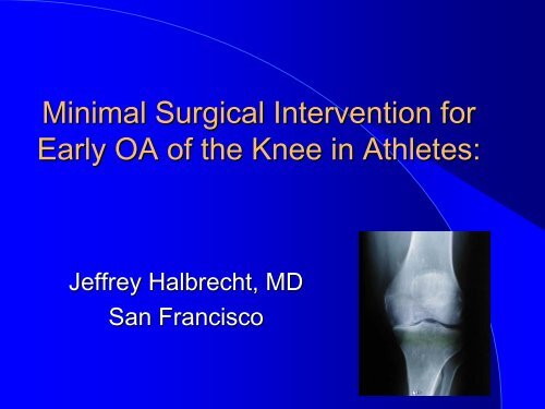 Minimal Surgical Intervention For Early OA Of The Knee In - IASM
