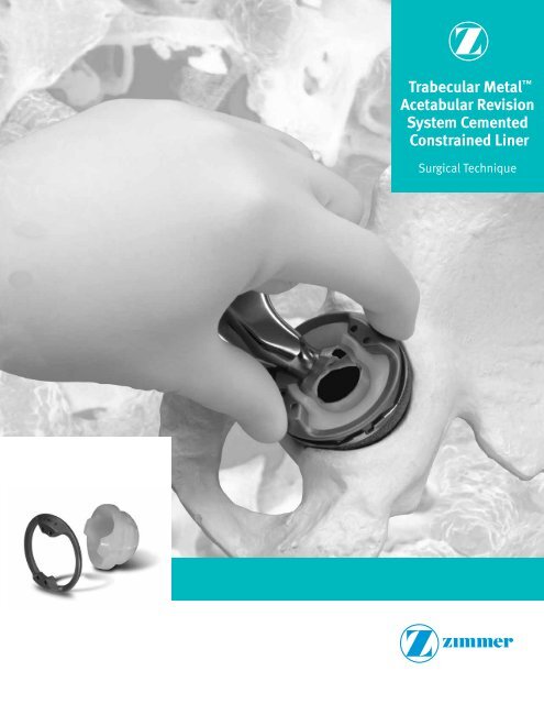Trabecular Metal Acetabular Revision System Cemented Constrained Liner