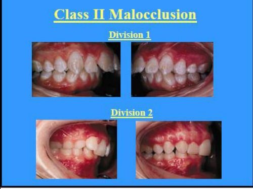 CLASSIFICATION OF MALOCCLUSION