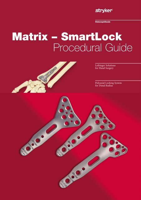Matrix SmartLock Operative Technique - Stryker
