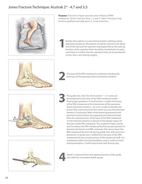 Jones Fracture Technique: