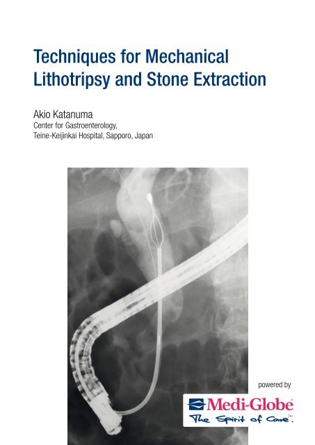 Techniques for Mechanical Lithotripsy and Stone Extraction