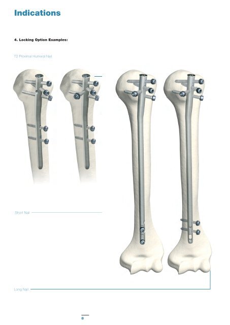 Indications 4. Locking Op