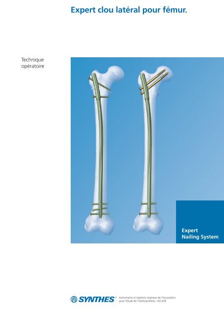 Technique opératoire - Synthes