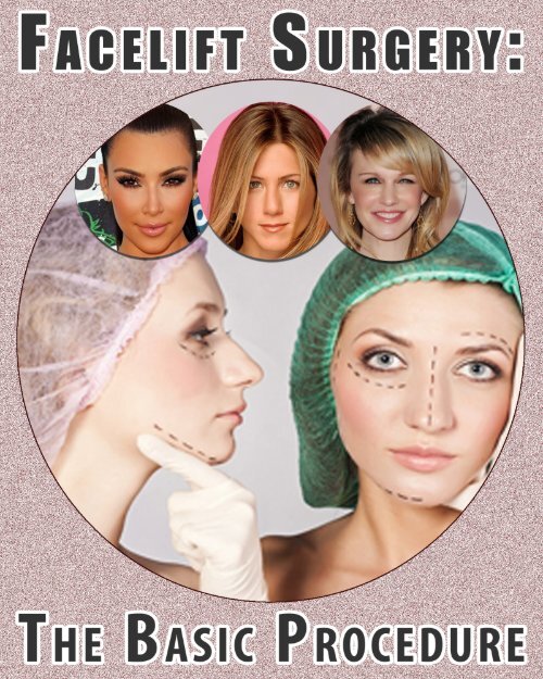 Facelift Surgery: The Basic Procedure