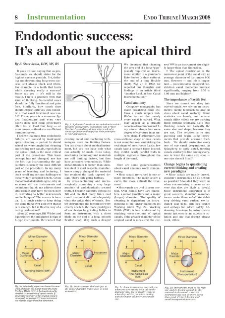 Endodontic success: It's all about the apical third - Health Mantra