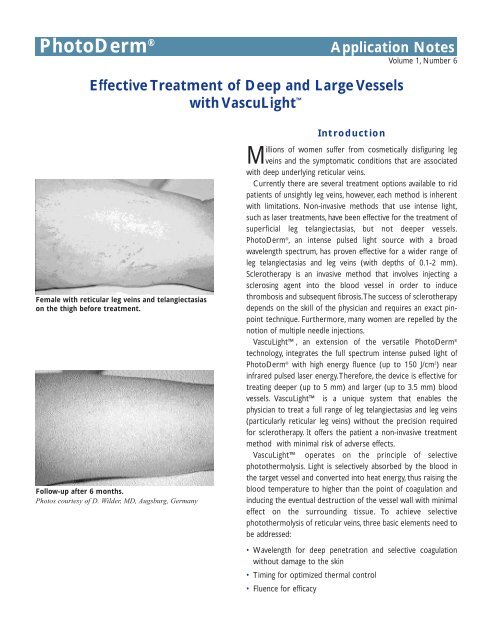 Effective Treatment of Deep and Large Veins(.pdf) - Lumenis Aesthetic