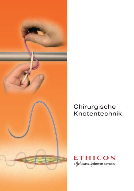 Chirurgische Knotentechnik - Ethicon