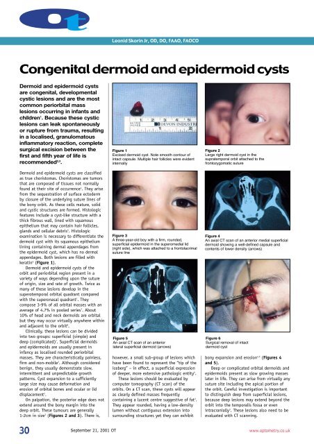 Congenital dermoid and epidermoid cysts