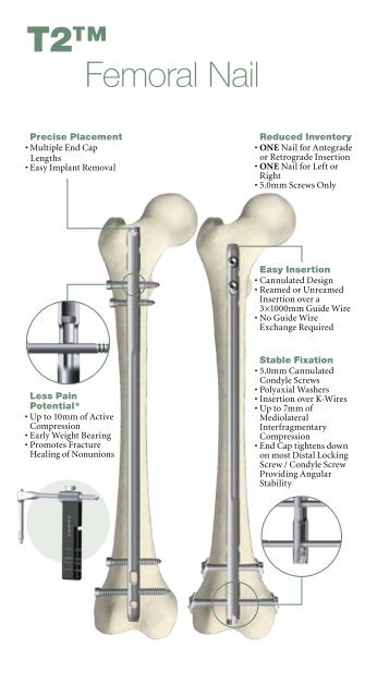 T2 Femoral