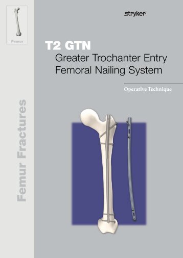 Expert Adolescent Lateral Femoral Nail. - Synthes