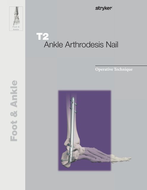 T2 Ankle Arthrodesis Operative Technique - Stryker