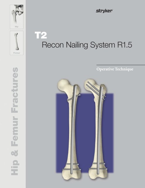 T2 Recon Nailing System R1.5 Operative Technique - Stryker