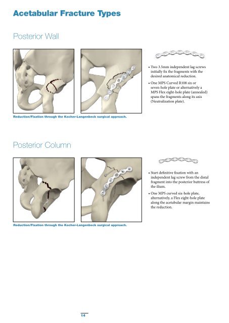 Acetabular