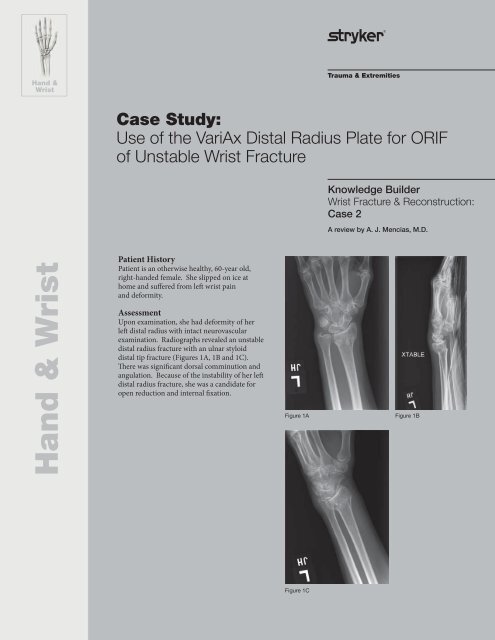 Case study : ORIF of Unstable Wrist Fracture - Stryker