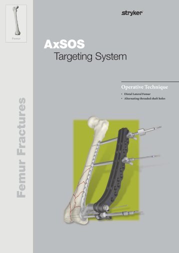 PeriLoc Proximal Femur Plate Technique.pdf - Bonerepmedical.com