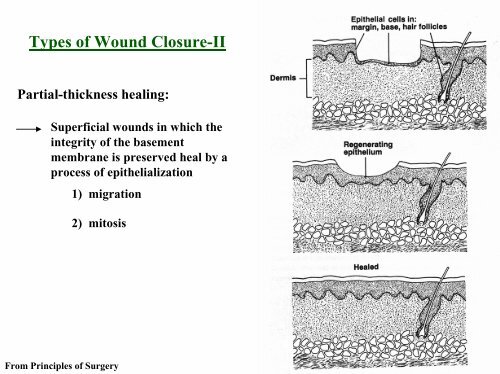 Types of Wound