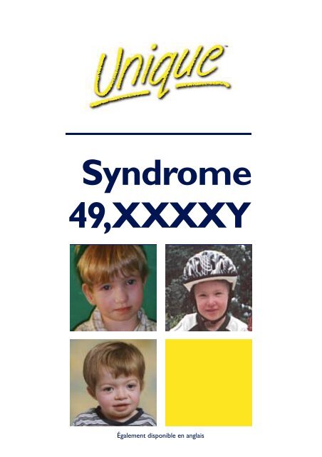 Syndrome 49,XXXXY - Unique - The Rare Chromosome Disorder ...