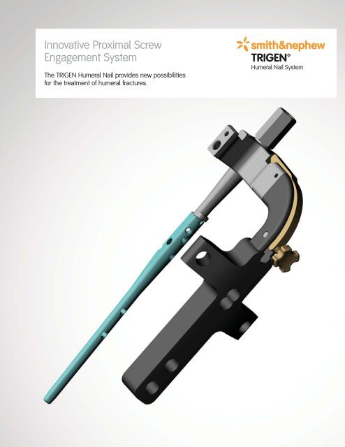 Innovative Proximal Screw Engagement System