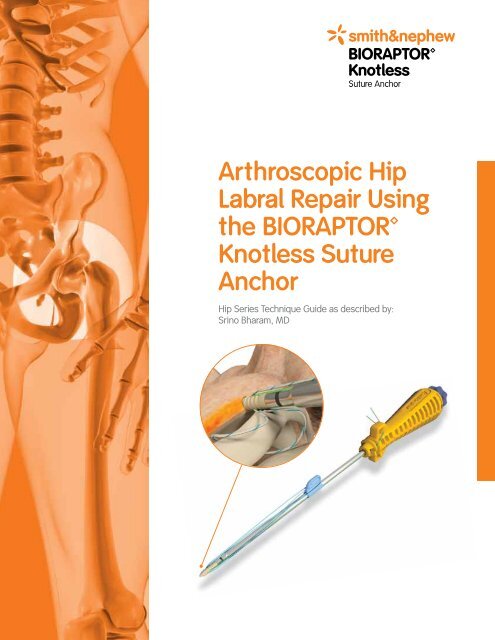 Arthroscopic Hip Labral Repair Using the BIORAPTORâ ¢ Knotless ...