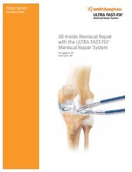 FAST-FIXâ ¢ 360 Meniscal Repair System - Smith & Nephew