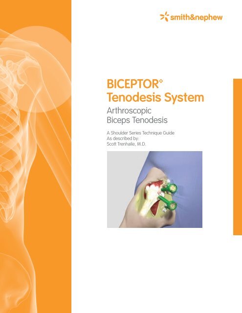BICEPTOR - Biceps - Smith & Nephew