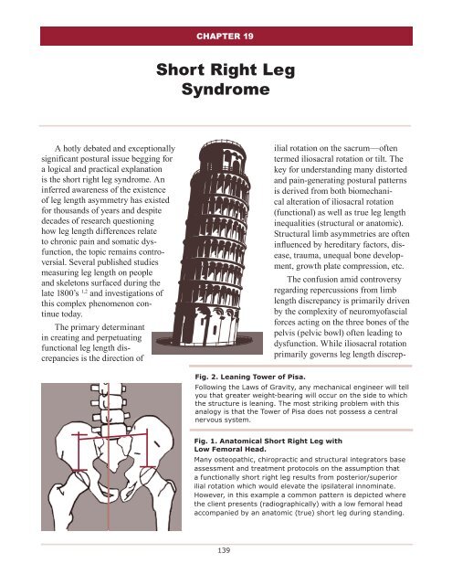 Short Right Leg Syndrome