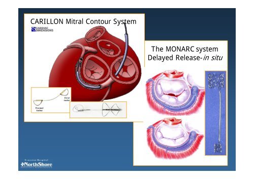 CARILLON Mitral Contour S