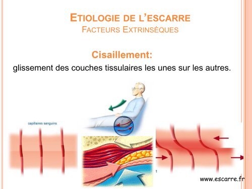 ETIOLOGIE DE L’ESCARRE