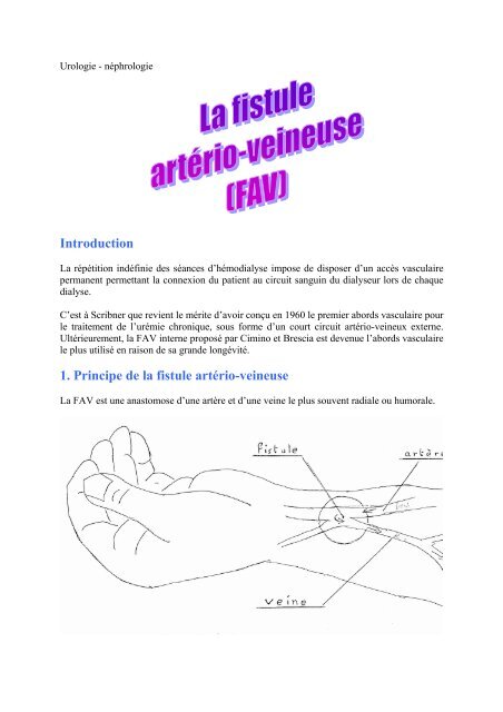 Introduction 1. Principe de la fistule artério-veineuse - Infirmiers.com