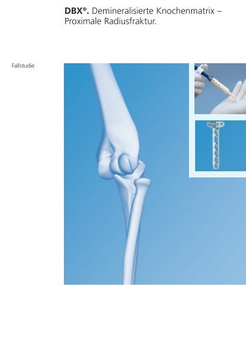 PFNA. Proximaler Femurnagel Antirotation. - Synthes