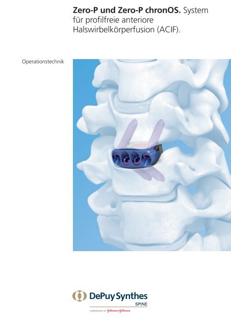 Zero-P und Zero-P chronOS. System für profilfreie ... - Synthes